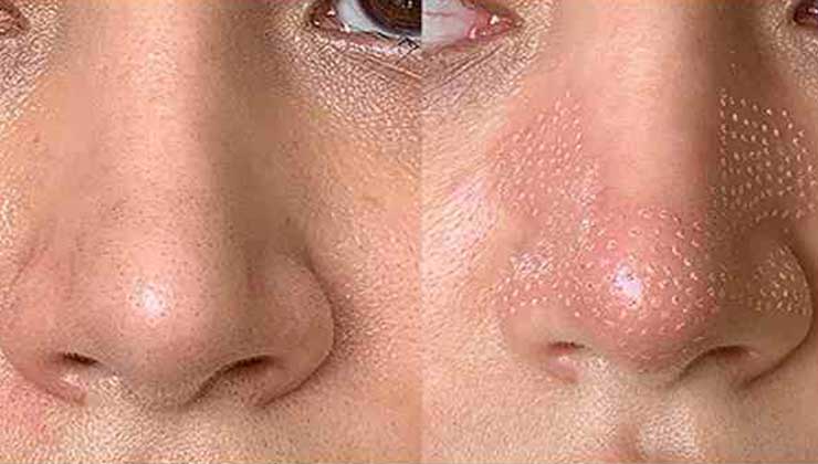 عوارض پلاسما جت بینی | قالب خبری ngpsco